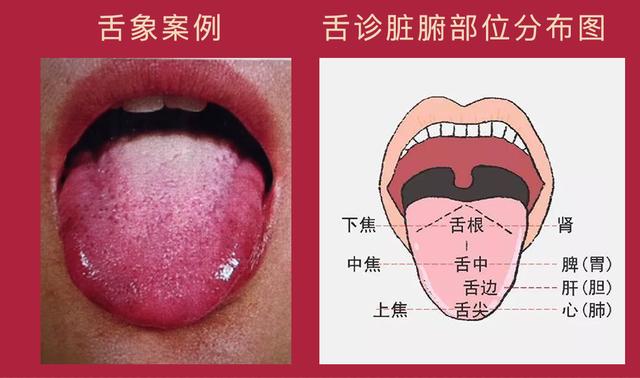 Simple tongue examination: what does the red and spotted tongue mean ...