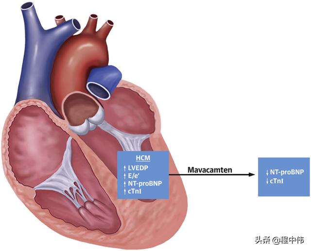 Symptomatic hypertrophic non-obstructive cardiomyopathy and Mavacamten ...