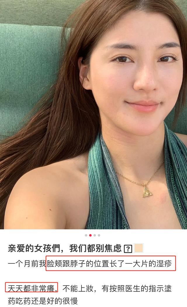 Wu Qianyu wears a suspender and has a beautiful back!Eczema on neck and cheeks is super itchy ...