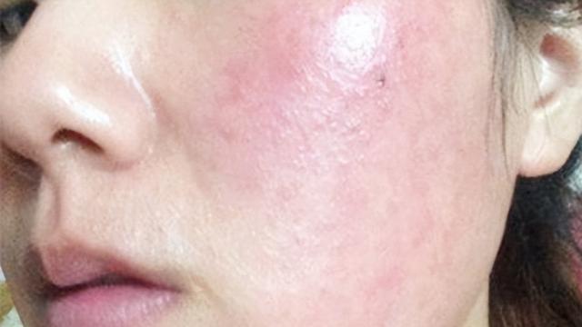 Facial flushing repeated for many years?This is how you can be saved ...