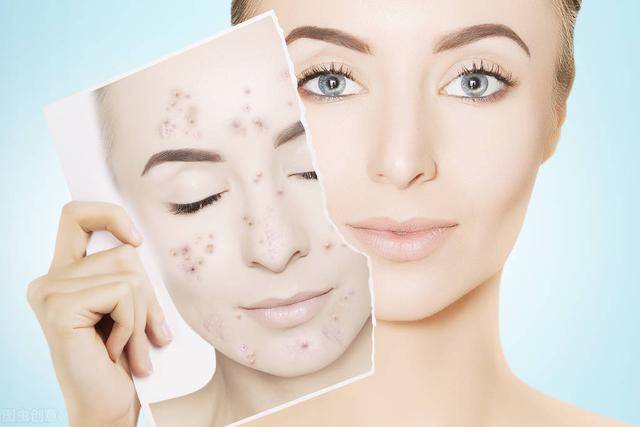 Get rid of acne through diet - iMedia