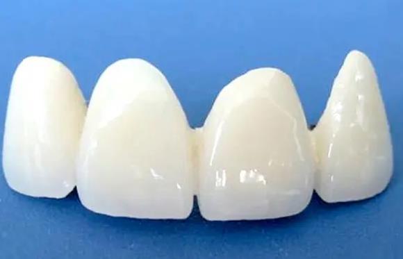 How long does it take to replace the previously made porcelain teeth ...