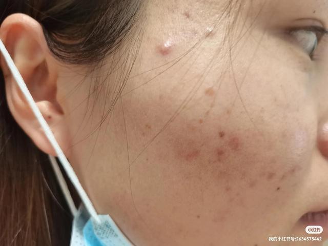 How to choose the treatment of acne marks and pits - iMedia