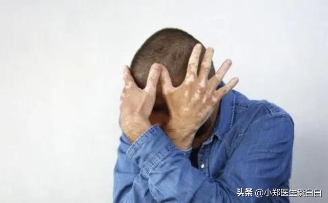 Some Common Problems With Vitiligo IMedia