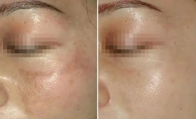 What are the manifestations of chloasma with Chong Ren disorder? - iMedia