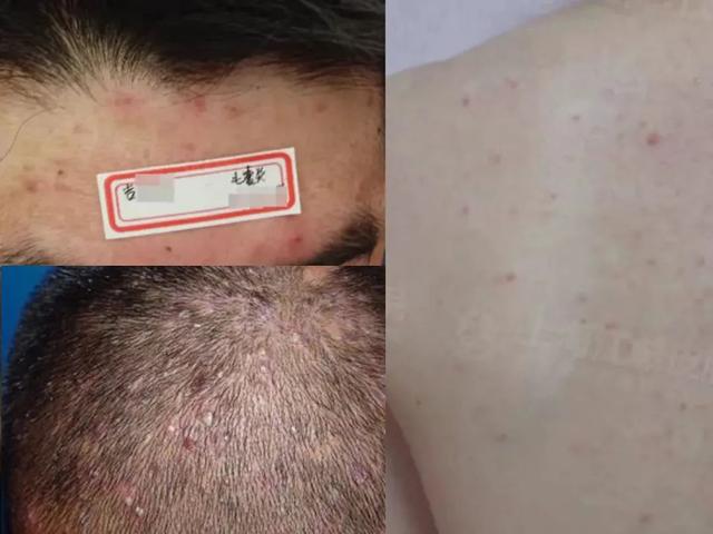 What does folliculitis look like?Causes and treatment of folliculitis ...