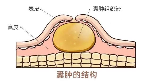 Most cysts do not need to be treated, but they appear in these five ...