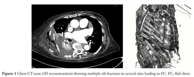 When, why and how to perform surgical fixation of flail chest after ...