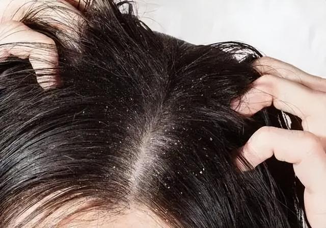 Kunming Scalp Management: How Does Dandruff Form? - iMedia