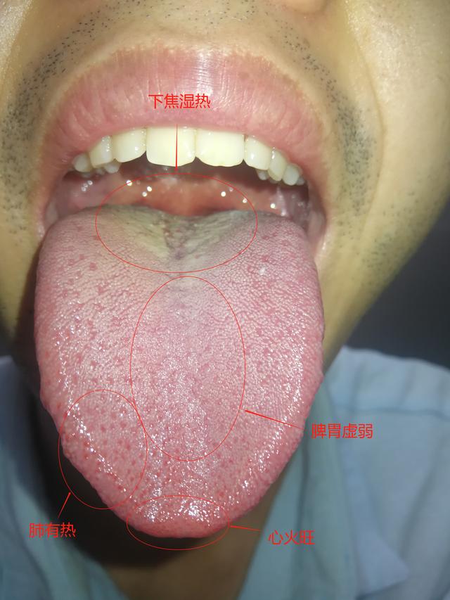 Analysis of fans' tongue images: spleen deficiency, what to do with ...