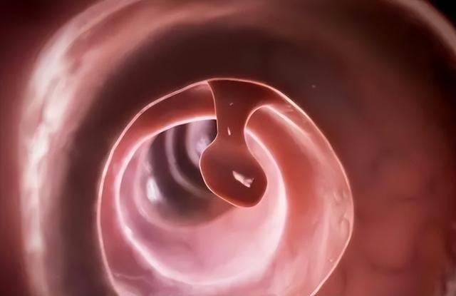 After cutting gastric polyps for so many years, do you understand the ...