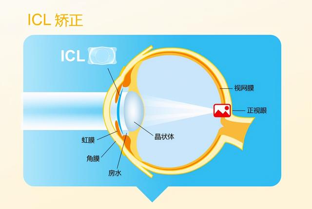 A complete guide to ICL lens implantation - iMedia