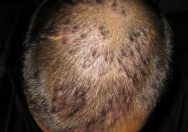 Why are there always red bumps and pustules on the scalp?What caused ...