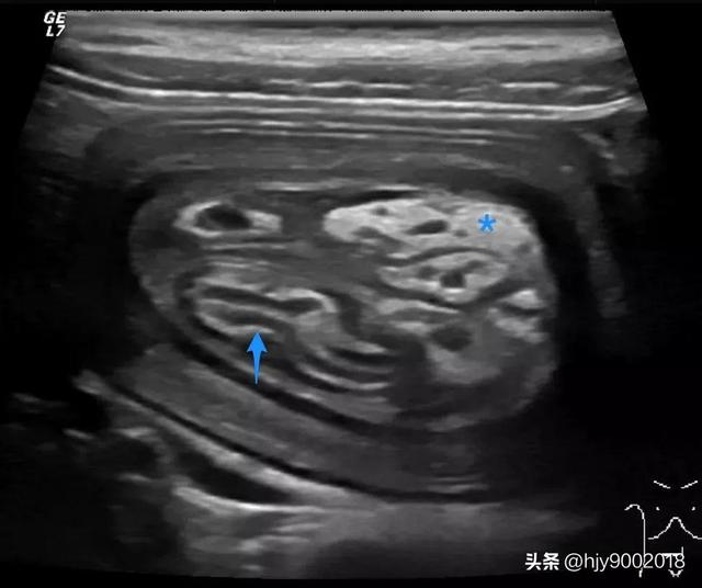 Diagnosis of canine intussusception by "crescent moon sign" on X-ray ...