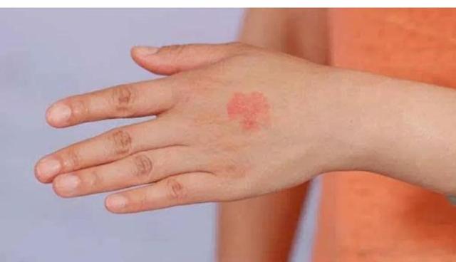 Birthmark, what past life message did God give you? - iMedia