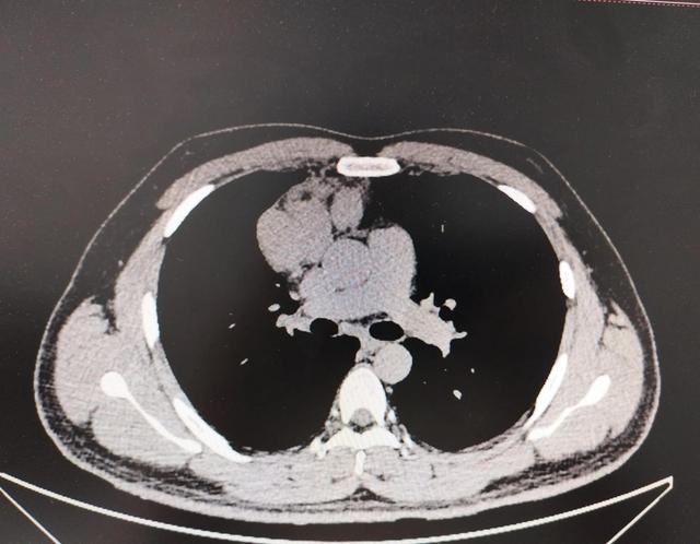 Surgical approach for thymic tumors, advantages of subxiphoid ...