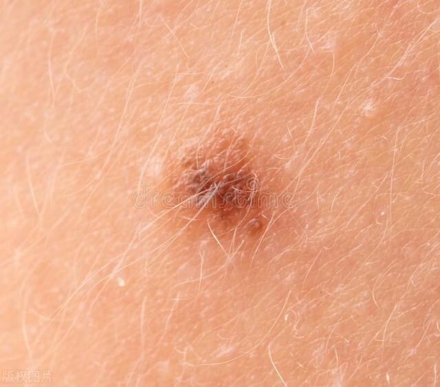 Birthmark Department of Beijing Lihe Medical Cosmetic Hospital: What to ...