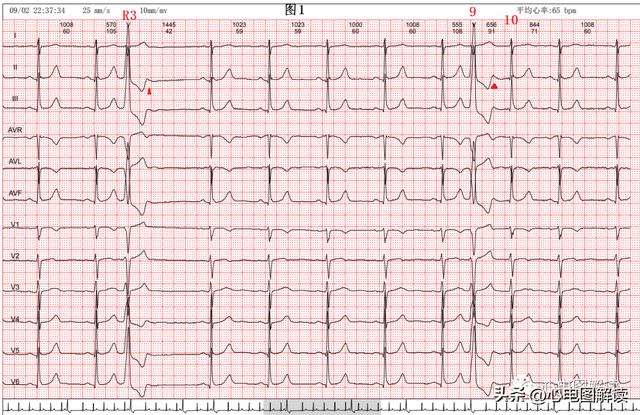 Premature ventricular contractions with fully compensated ...