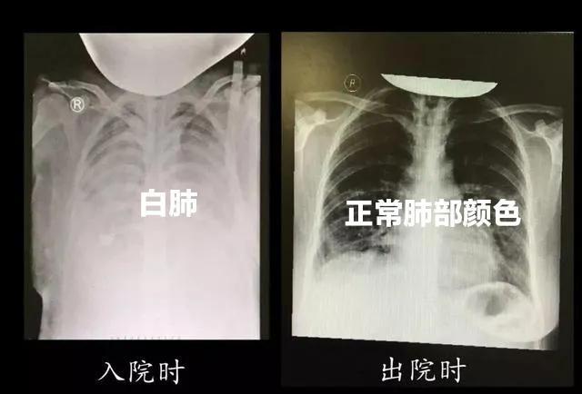 What color are our lungs?Why do white lungs appear?Is it serious? - iMedia
