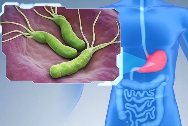 When Helicobacter pylori appears, there may be 5 abnormalities in the ...