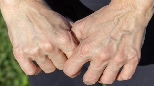 Why do some people have blue veins on their arms, but some people can't ...