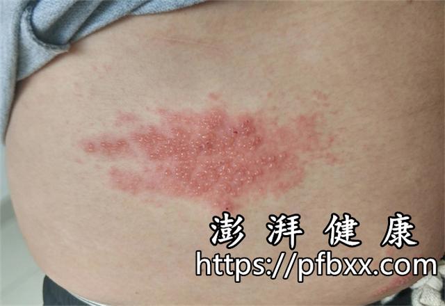 How to treat pain and itching after herpes zoster scabs - iMedia