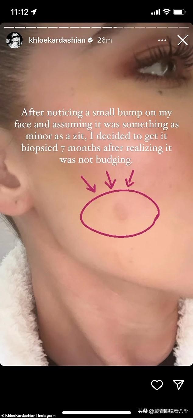 Khloe Kardashian Sunburns Cheek Scars Reveals Lumps On Her Face And Khloe Kardashian Sunburns Cheek Scars Reveals Lumps On Her Face And