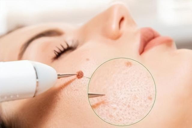 Moles are red, swollen and pitted, do you want to smooth them out? How ...