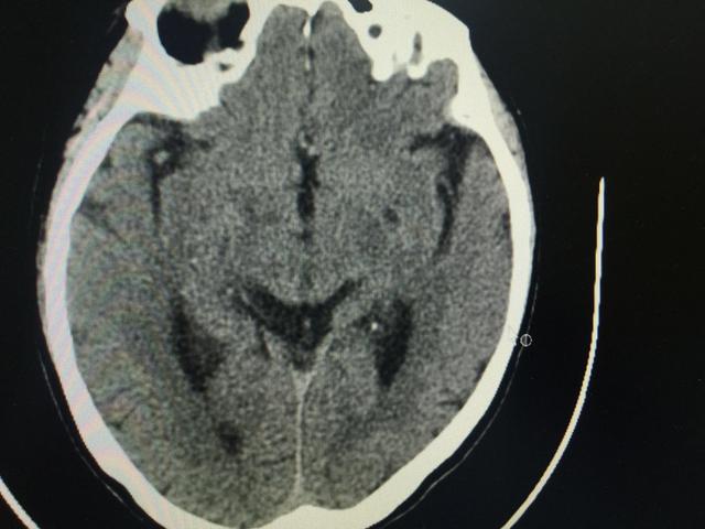 Lacunar cerebral infarction need to take medicine? - iMedia