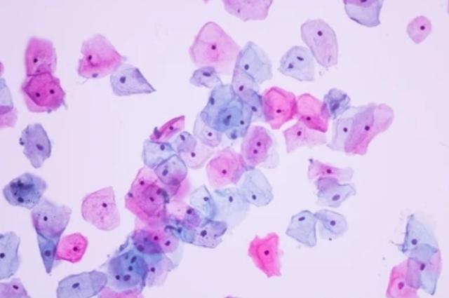 Patling Biotech talks about how to clear HPV: from pathogen to clinical ...