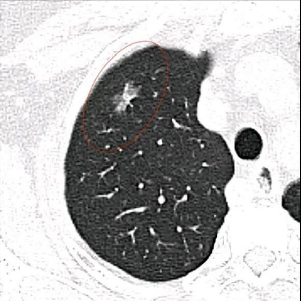 Mother encounters high-risk multiple pulmonary nodules in her son ...