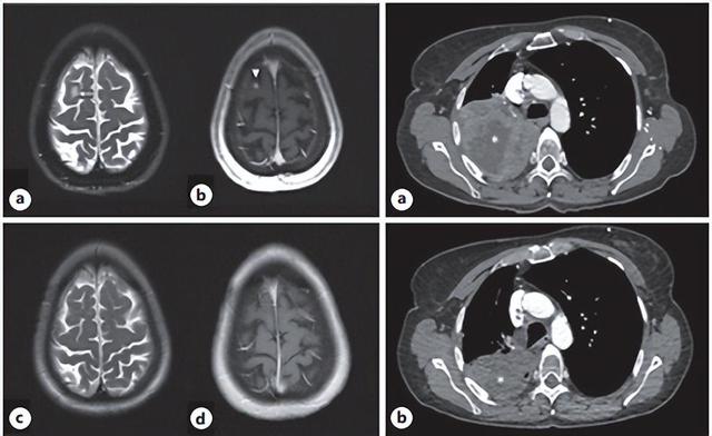 AMG 510 in KRAS G12C-mutated and untreated NSCLC patients with active ...