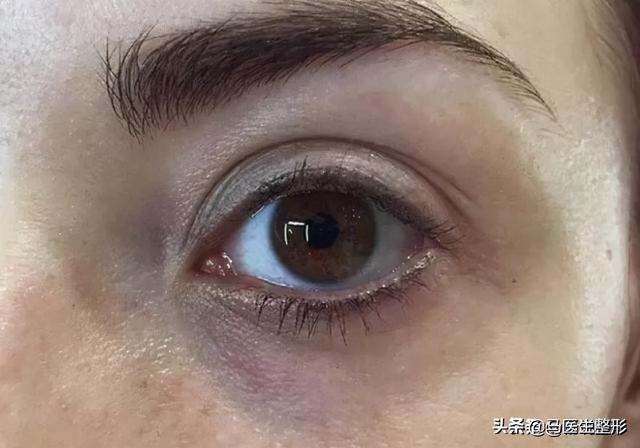 Why can't your dark circles get rid of?You must understand this ...