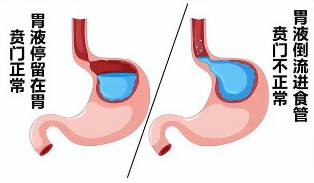 What are the symptoms of cardia cancer?How to carry out treatment and ...