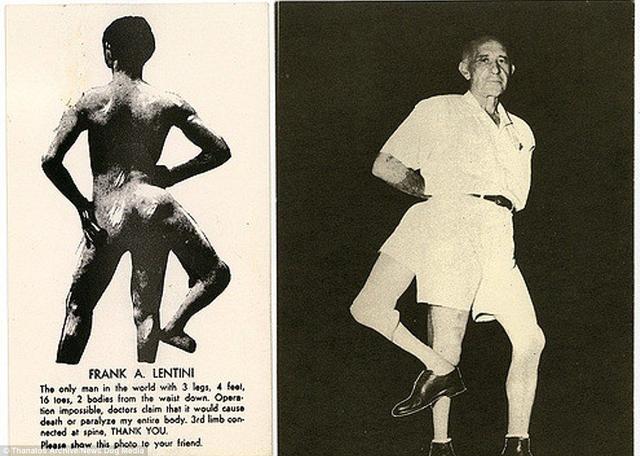 Frank Lentini: Three-legged, 16-fingered and two-genital juggler - iMedia