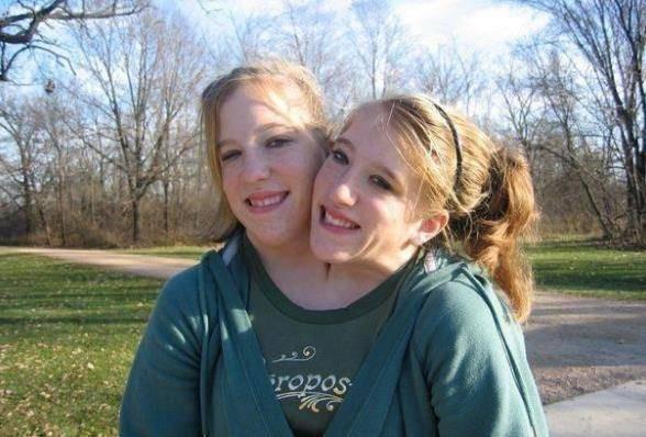 American Conjoined Twins: Sharing the same body and marrying the same ...