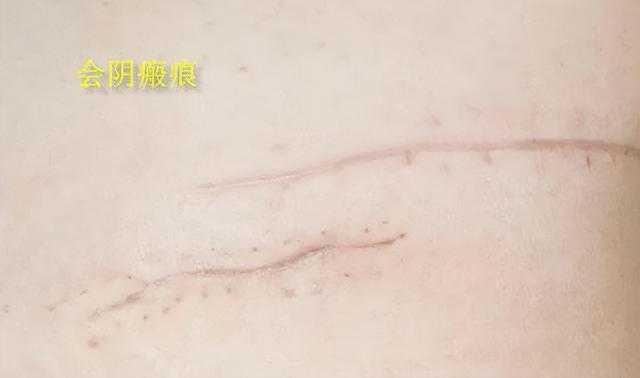 Perineal scar after childbirth, how can it cause pain - iMedia