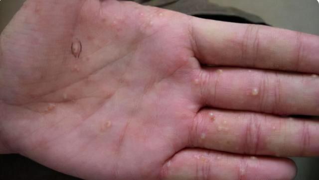 What should I do if the "small blisters" growing on my hands are ...