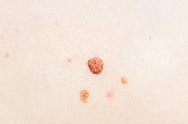 Birthmark science: the probability of canceration of congenital ...