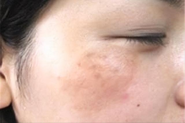 What are the manifestations of chloasma caused by liver depression and ...