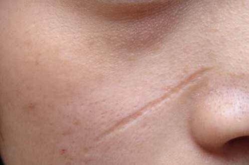 How to fix sunken scars on the face - iMedia