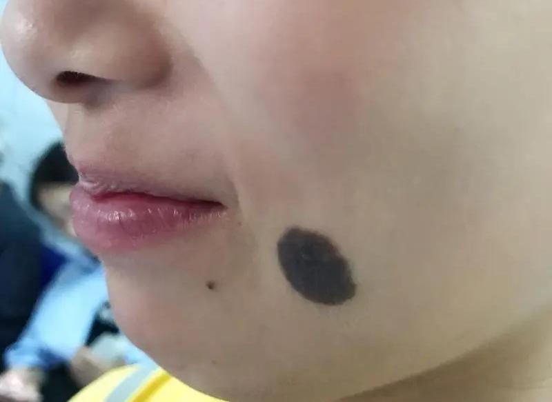 Beware of black hairy moles, beware of lesions - iNEWS