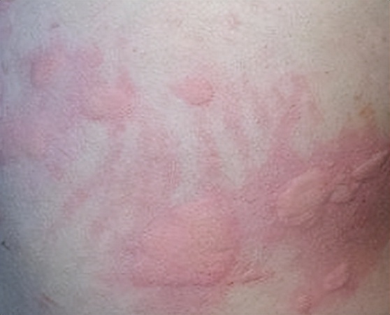 "Suspected skin disease" What's the matter with itchy skin at night ...