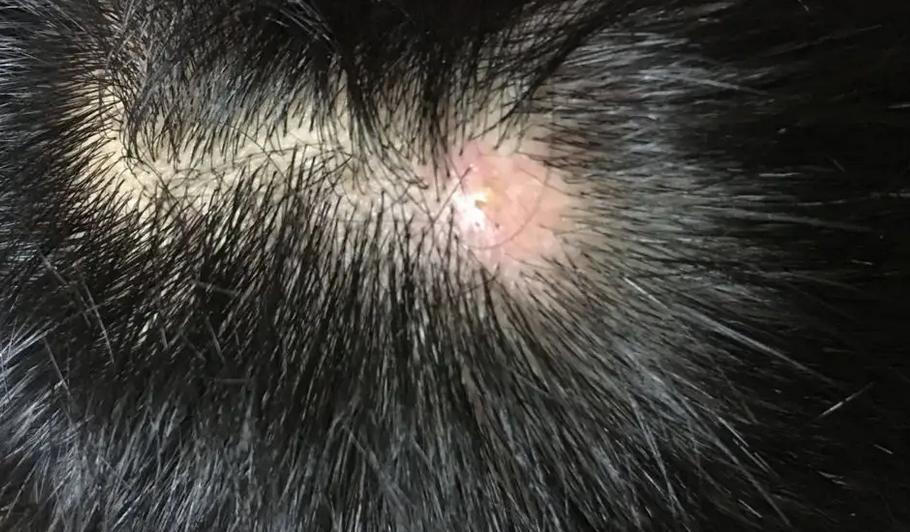 The scalp always has pimples and pustules, or these 3 diseases are ...