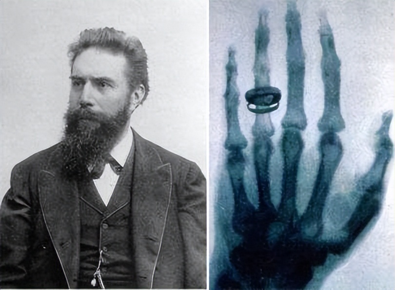 The development history of X-ray technology - iNEWS