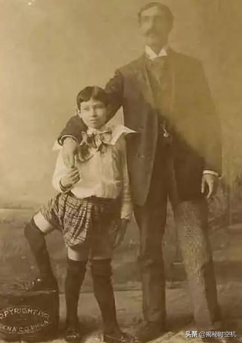 Anecdote: A man with 3 legs and 2 reproductive systems, married two ...