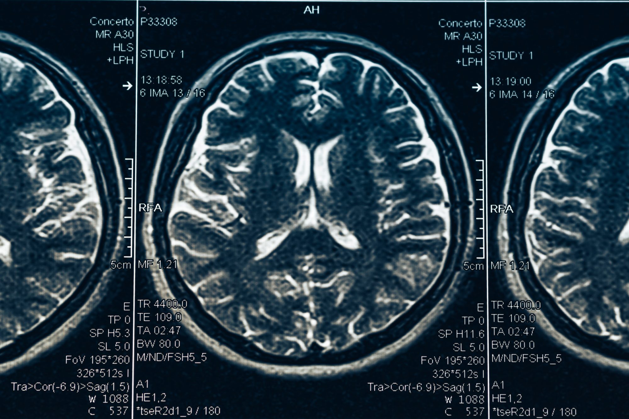 "Zombie gene" found in the human body: abnormally active hours after ...
