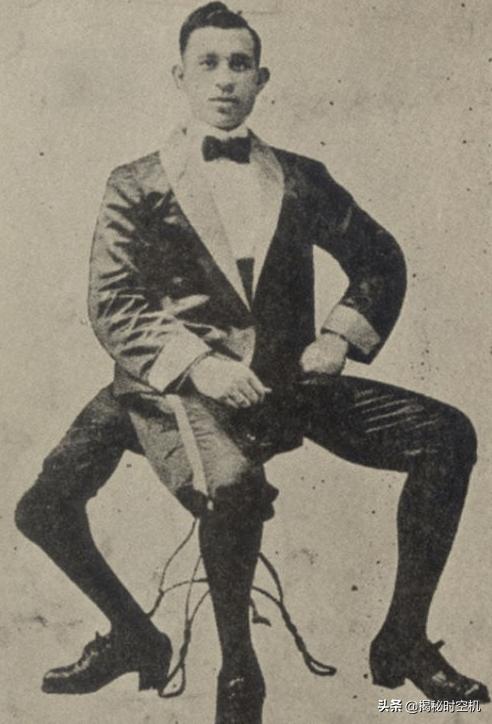 Anecdote: A man with 3 legs and 2 reproductive systems, married two ...