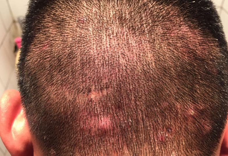 The scalp always has pimples and pustules, or these 3 diseases are ...